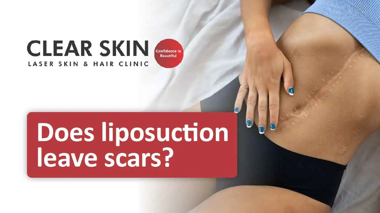 Does liposuction leave scars? - Dr. DC